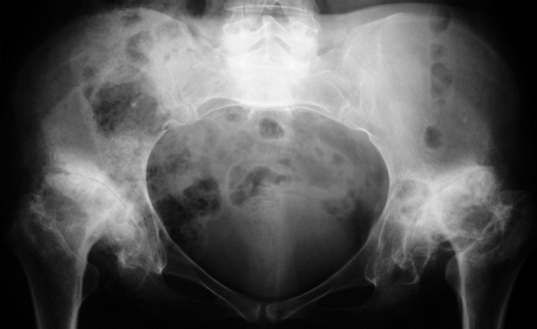 SEMEIOTICA RADIOLOGICA E SCALE DI VALUTAZIONE DELL’ARTROSI IN ...